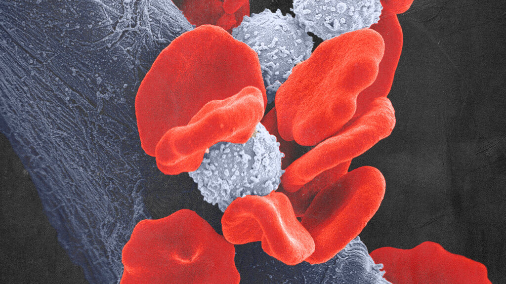 How does leukemia affect the body? PICCsox® PICC Line Covers